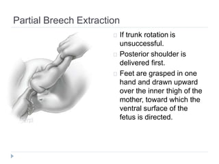 breech presentation.pptx