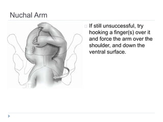breech presentation.pptx