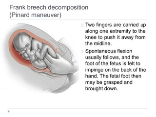 breech presentation.pptx