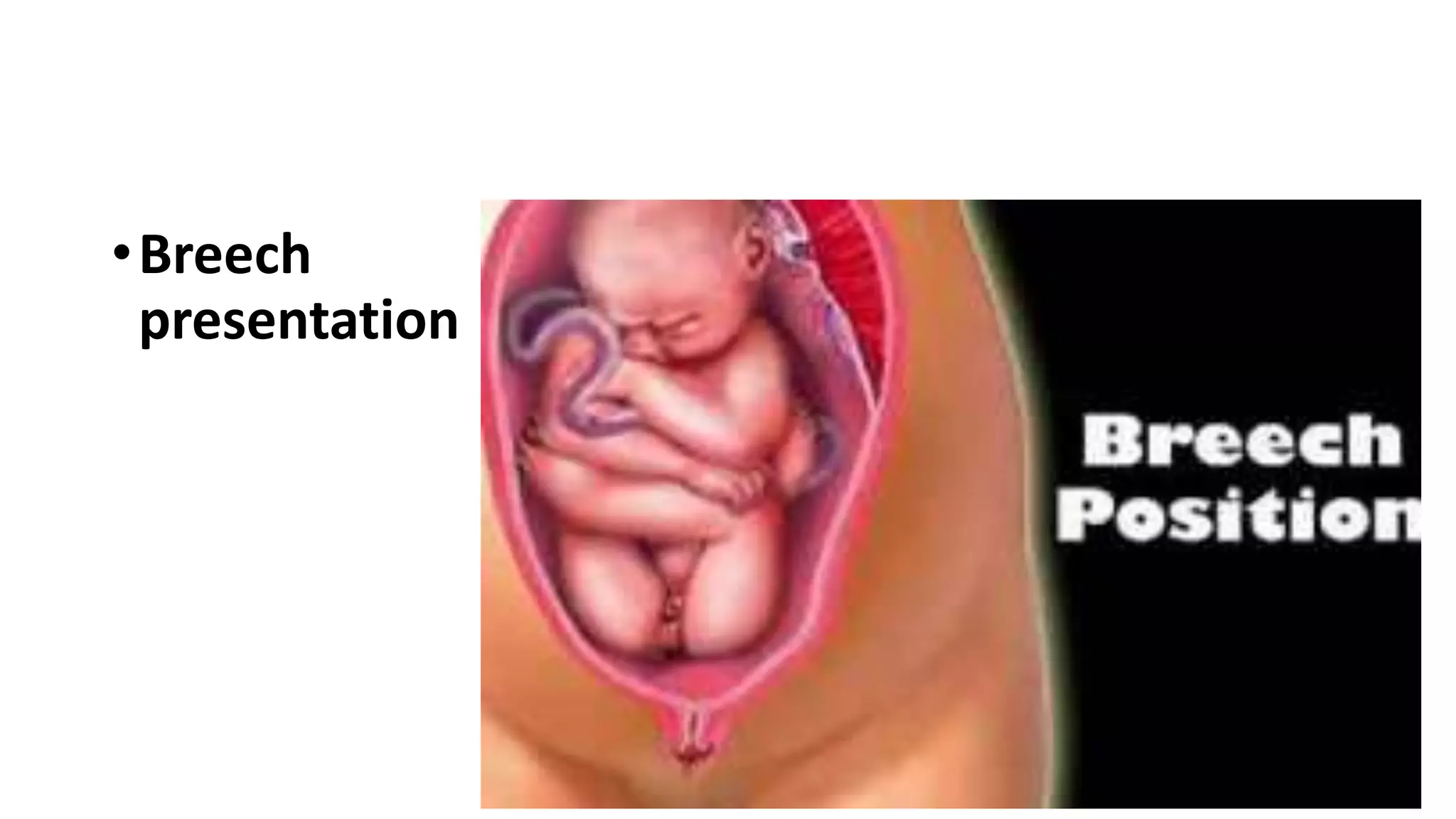 Breech presentation.pptx