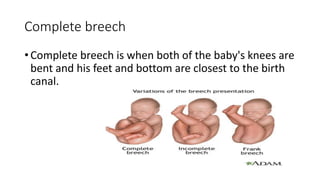 Breech presentation.pptx