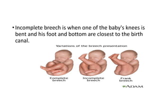 Breech presentation.pptx