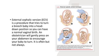 Breech presentation.pptx