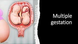 Breech presentation.pptx