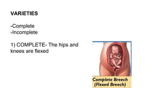 Breech presentation..pptx