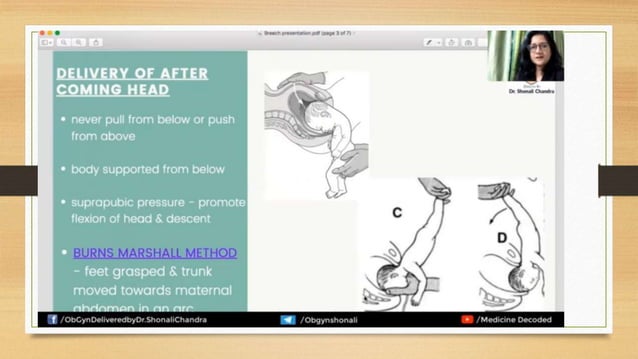 BREECH PRESENTATION, TYPES, DELIVERY.pptx | Pregnancy | Reproductive Health