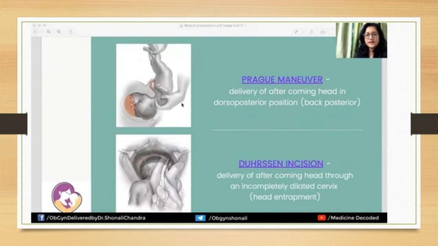 BREECH PRESENTATION, TYPES, DELIVERY.pptx | Pregnancy | Reproductive Health