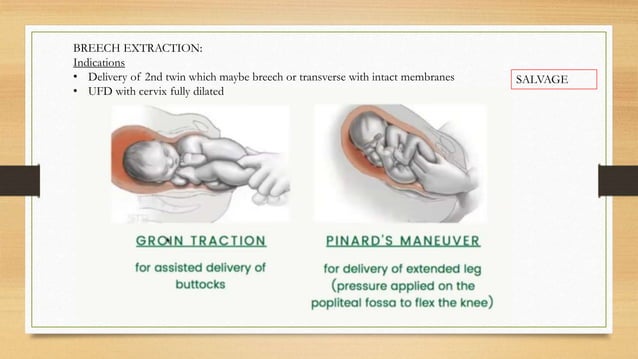 BREECH PRESENTATION, TYPES, DELIVERY.pptx | Pregnancy | Reproductive Health
