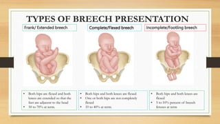 BREECH PRESENTATION, TYPES, DELIVERY.pptx | Pregnancy | Reproductive Health