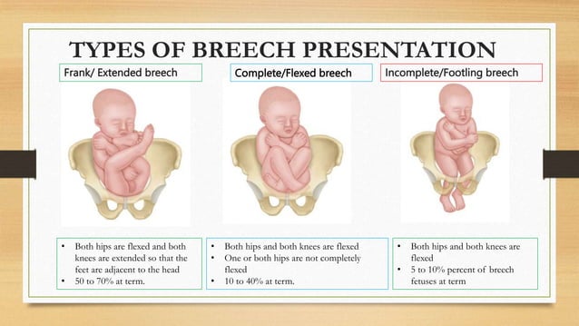 BREECH PRESENTATION, TYPES, DELIVERY.pptx | Pregnancy | Reproductive Health