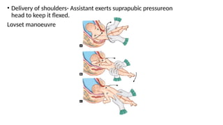 BREECH PRESENTATION & MANAGEMENT OBS.pptx