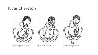 BREECH PRESENTATION & MANAGEMENT OBS.pptx