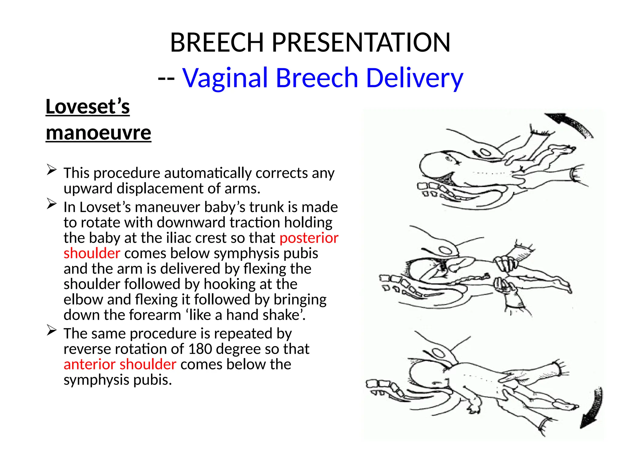 work up Breech presentation details.pptx