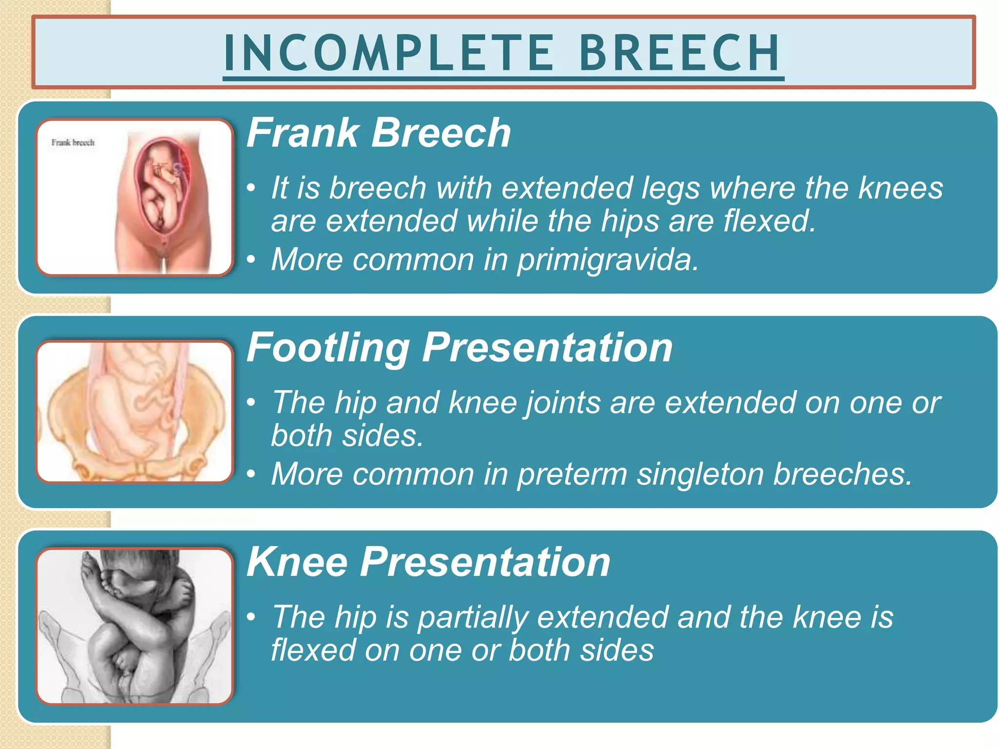 Breech presentation | PPTX