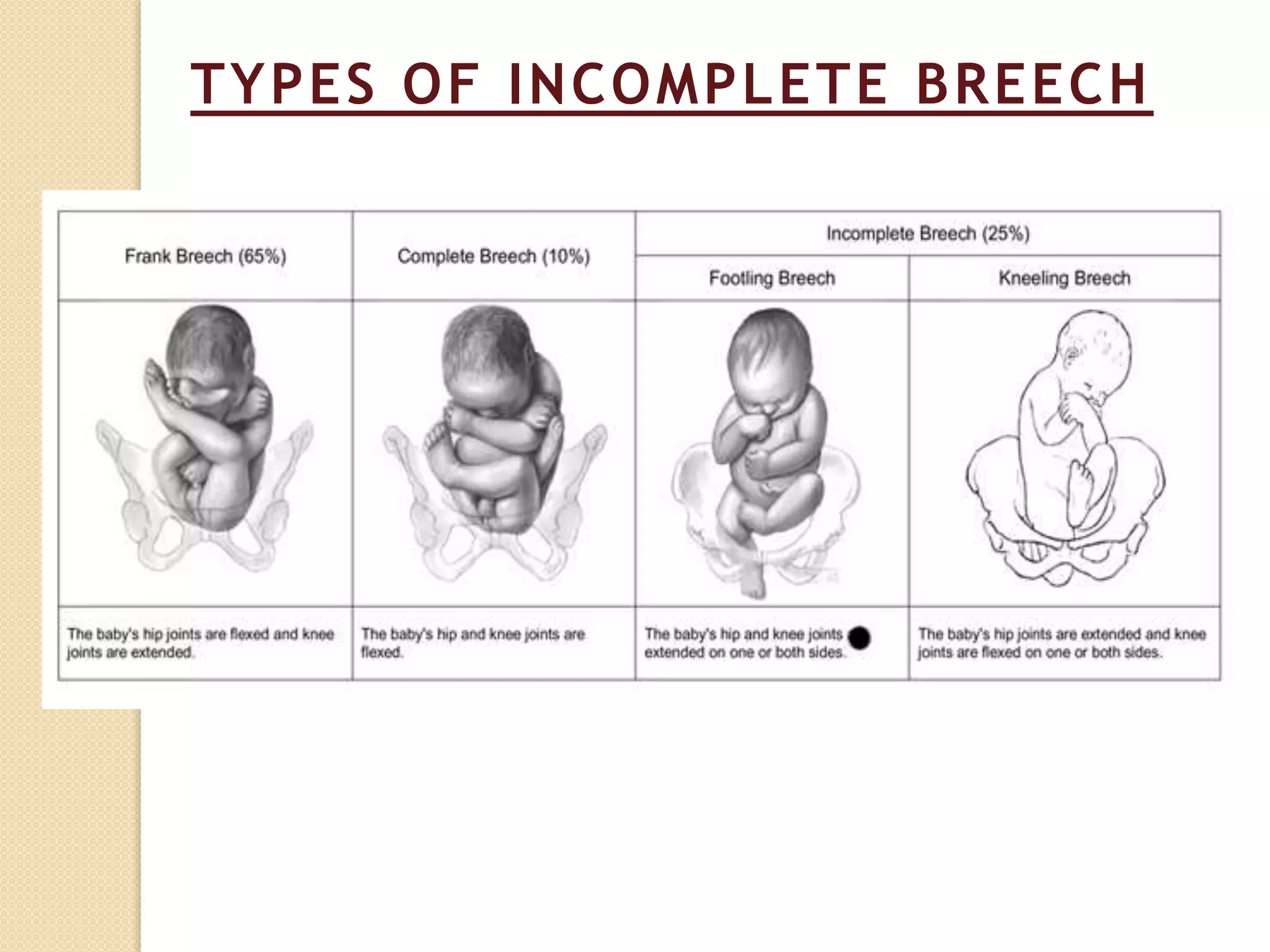 Breech presentation | PPTX