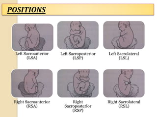 Breech presentation | PPTX