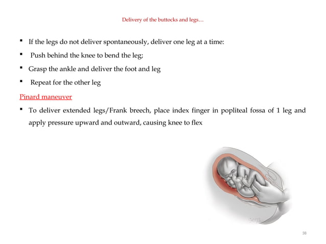 Breech Presentation 12.pptxggggbcxxxcccc | PPT