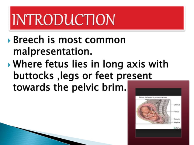 BREECH PRESENTATION abnormal condition.pptx