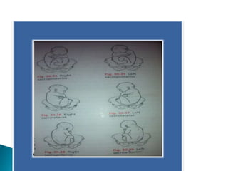 BREECH PRESENTATION abnormal condition.pptx