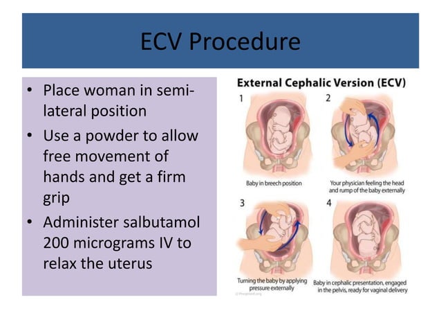 Breech presentation and delivery | PPTX