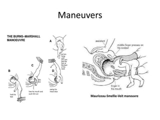 Breech presentation and delivery | PPTX