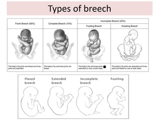Breech presentation and delivery PPT