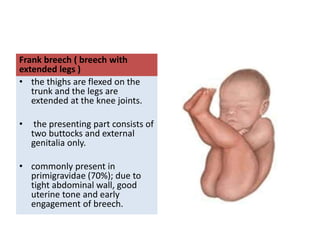 Breech presentation and delivery | PPT