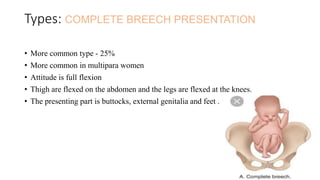 BREECH PRESENTATION Anju.pptx