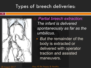 Breech presentation for 4th year med.students | PPT