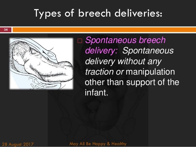 Breech presentation for 4th year med.students