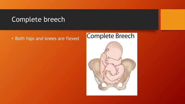 Breech presentation new 1.pdf