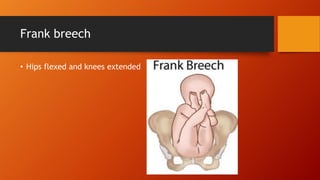 Breech presentation new 1.pdf