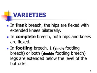 Breech presentation | PPTX