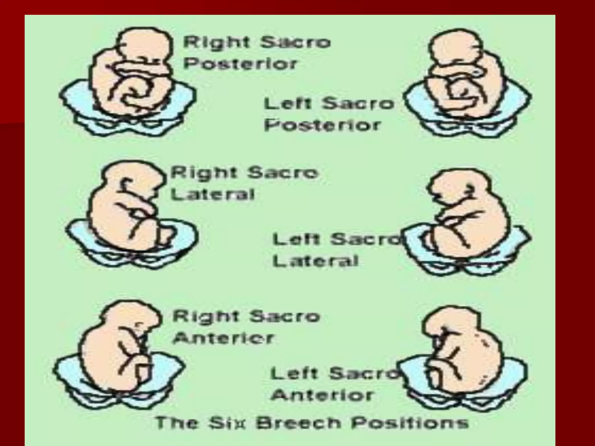 Breech Presentation & transverse lie.ppt