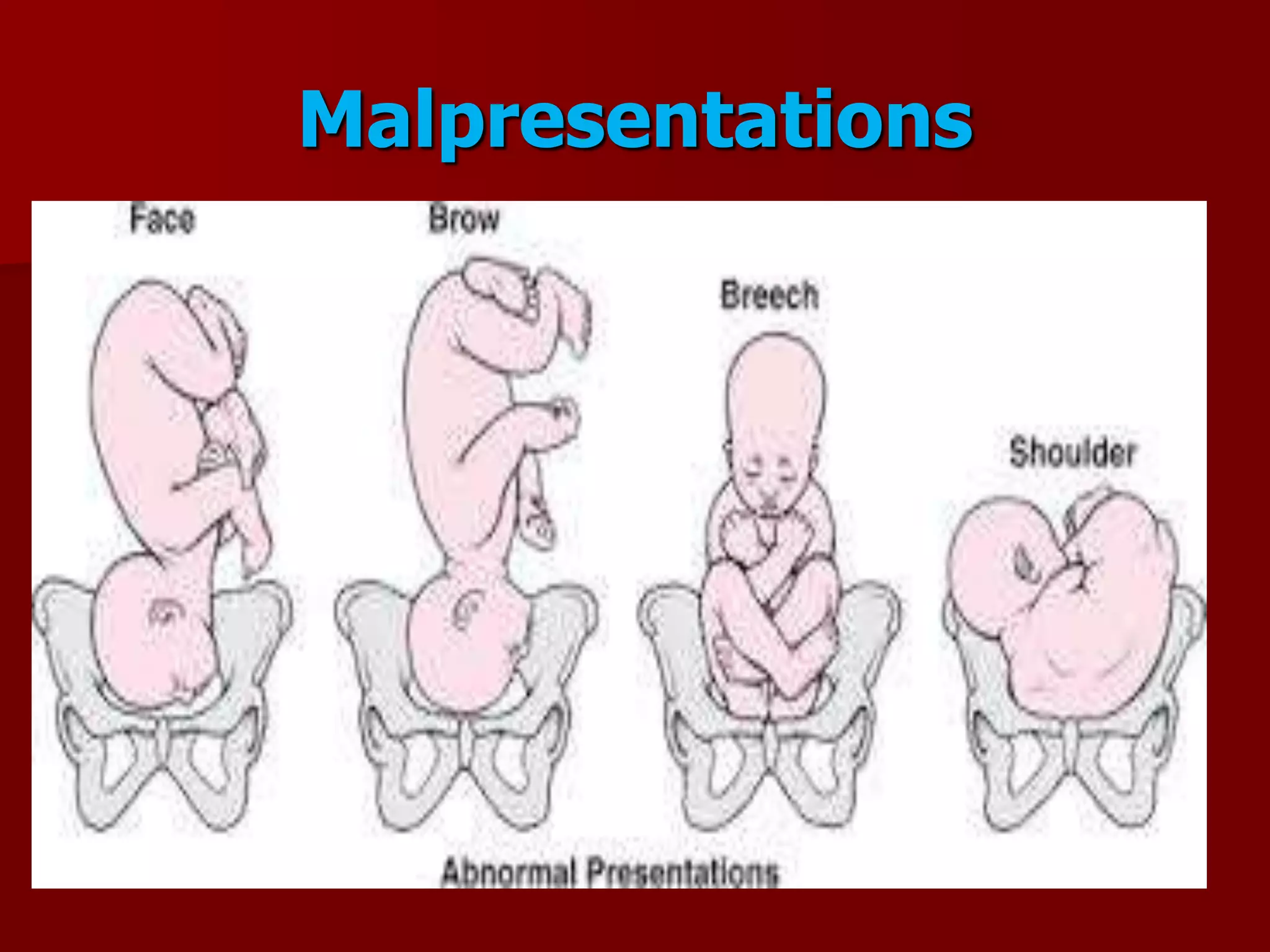 Breech Presentation & transverse lie.ppt