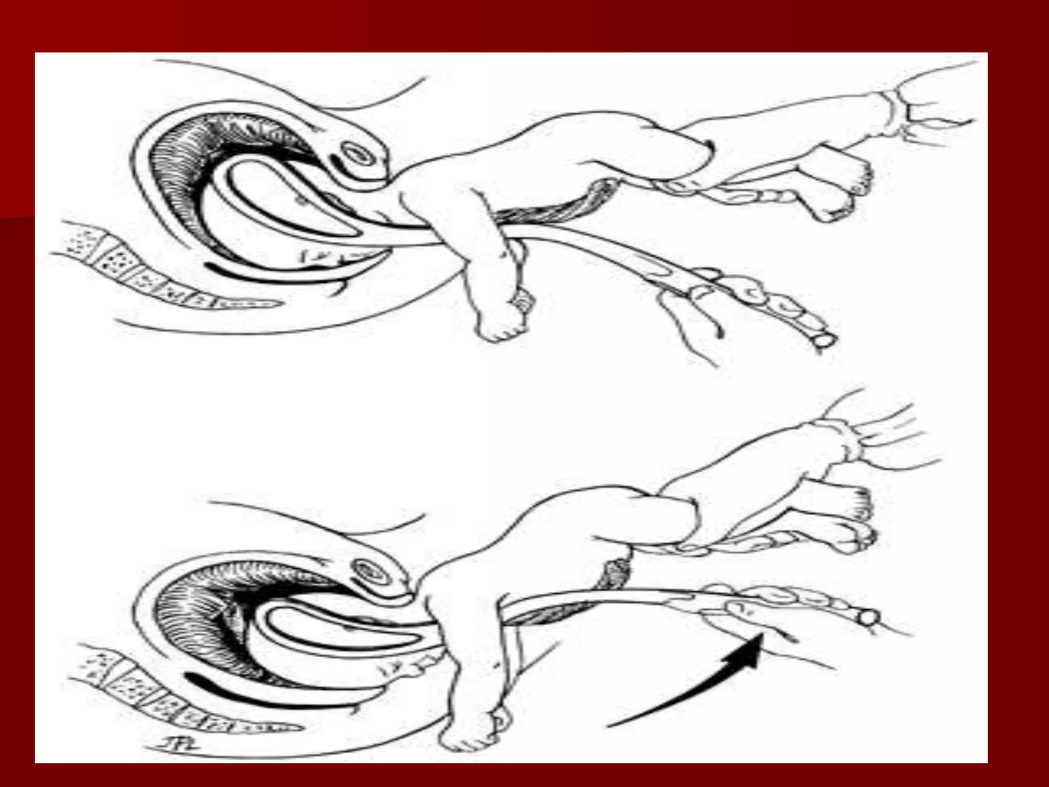 Breech Presentation & transverse lie.ppt