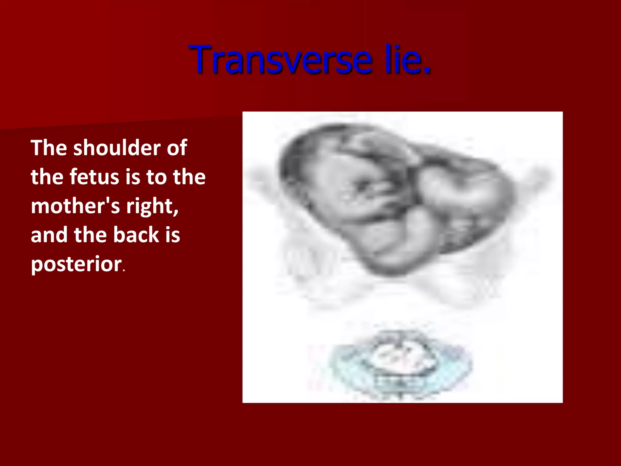 Breech Presentation & transverse lie.ppt