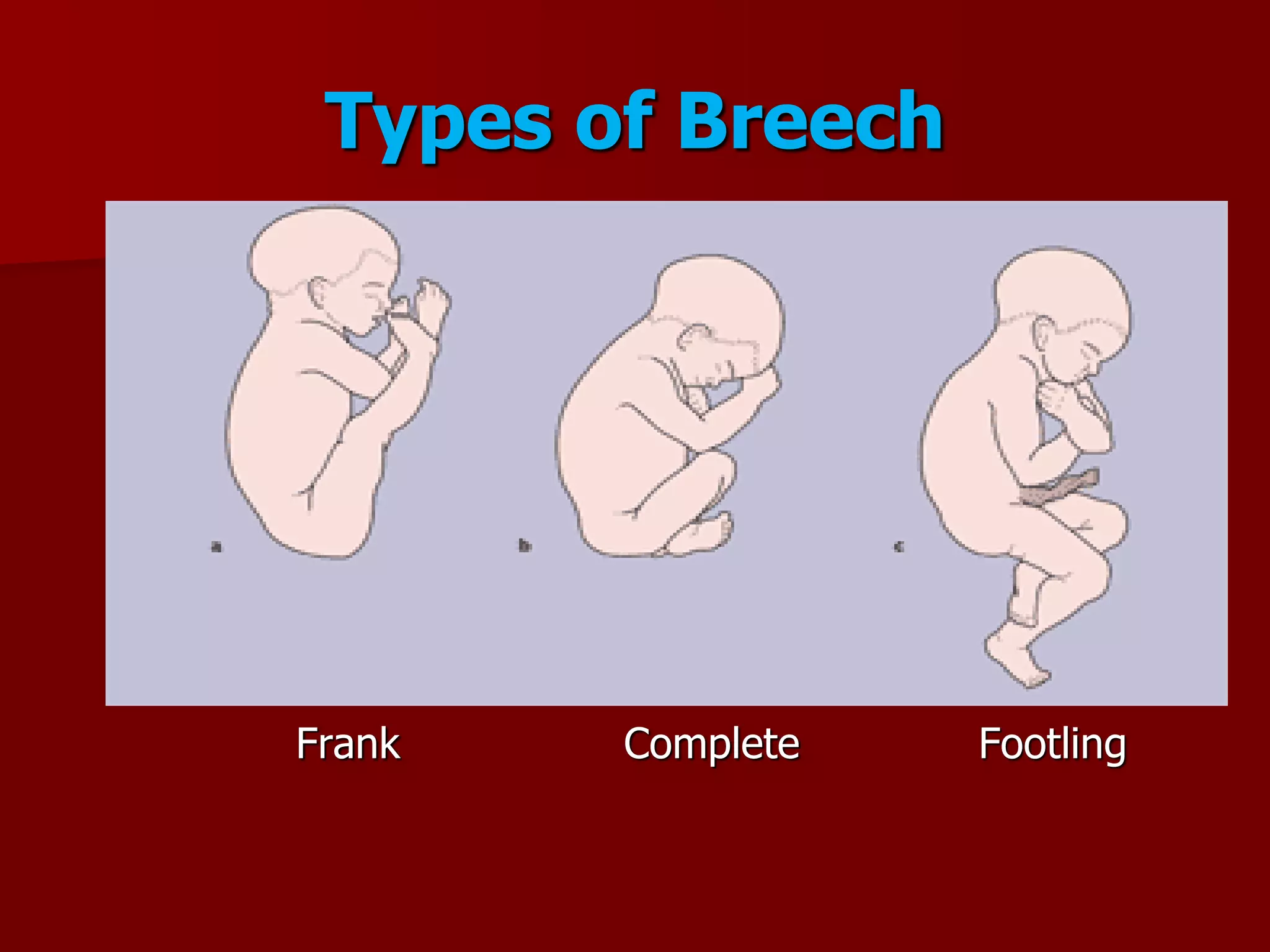 Breech Presentation & transverse lie.ppt