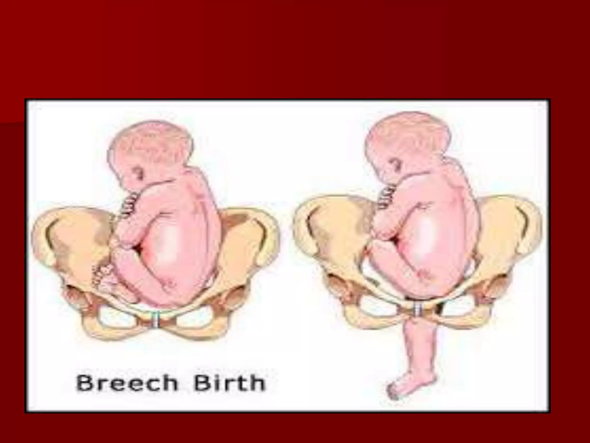 Breech Presentation & transverse lie.ppt