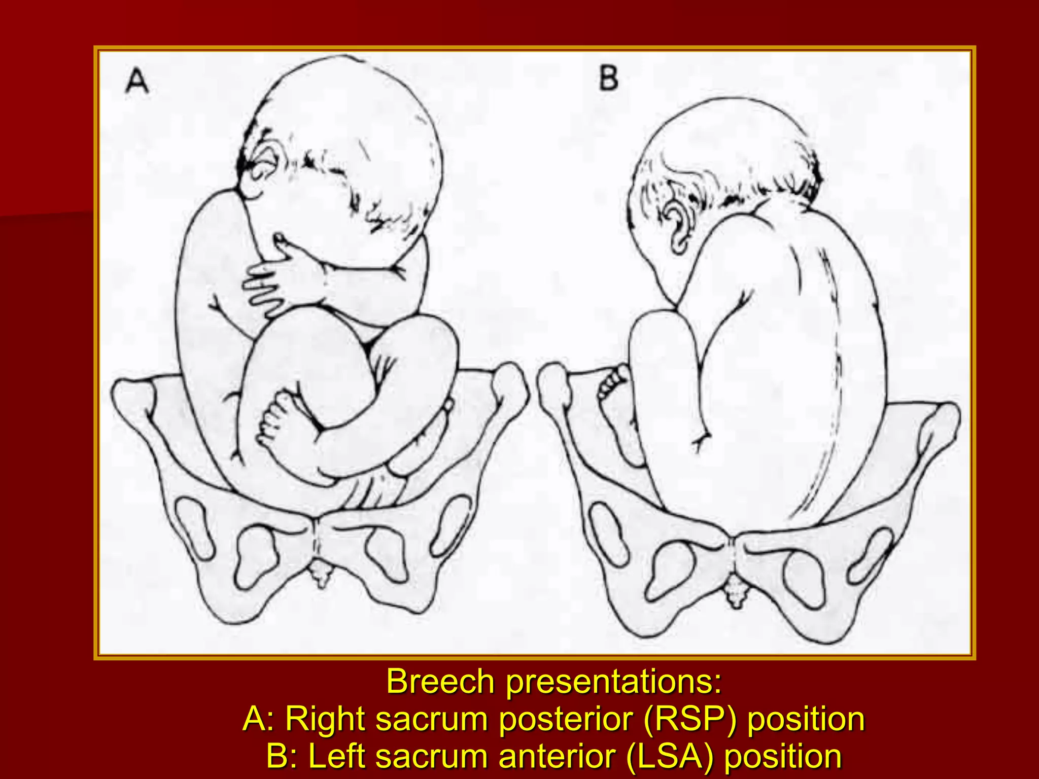 Breech Presentation & transverse lie.ppt