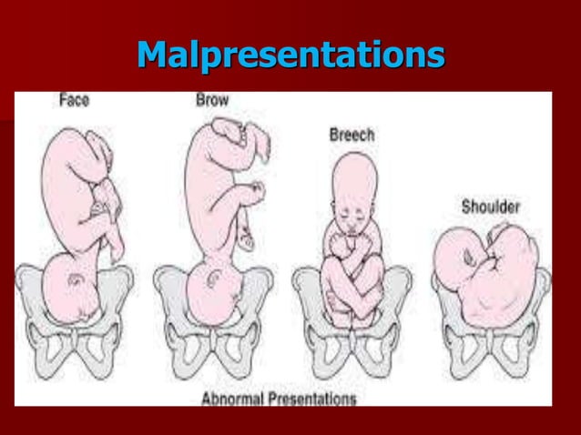 Breech Presentation & transverse lie.ppt