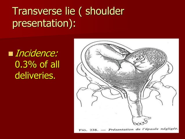 Breech Presentation & transverse lie.ppt