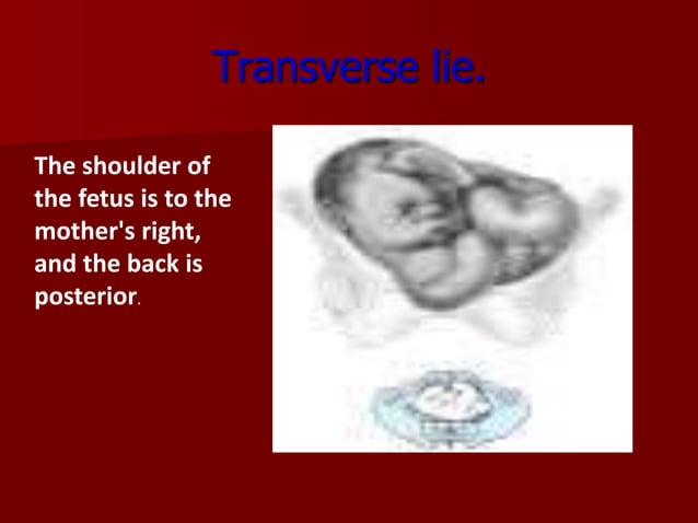 Breech Presentation & transverse lie.ppt