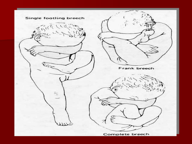 Breech Presentation & transverse lie.ppt