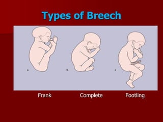 Breech Presentation & transverse lie.ppt