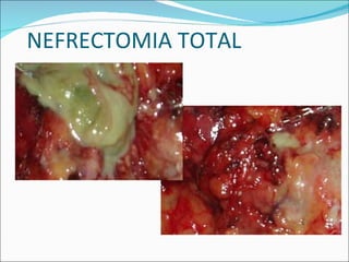 Cirurgia Videolaparoscópica do Cálculo Renal | PPT