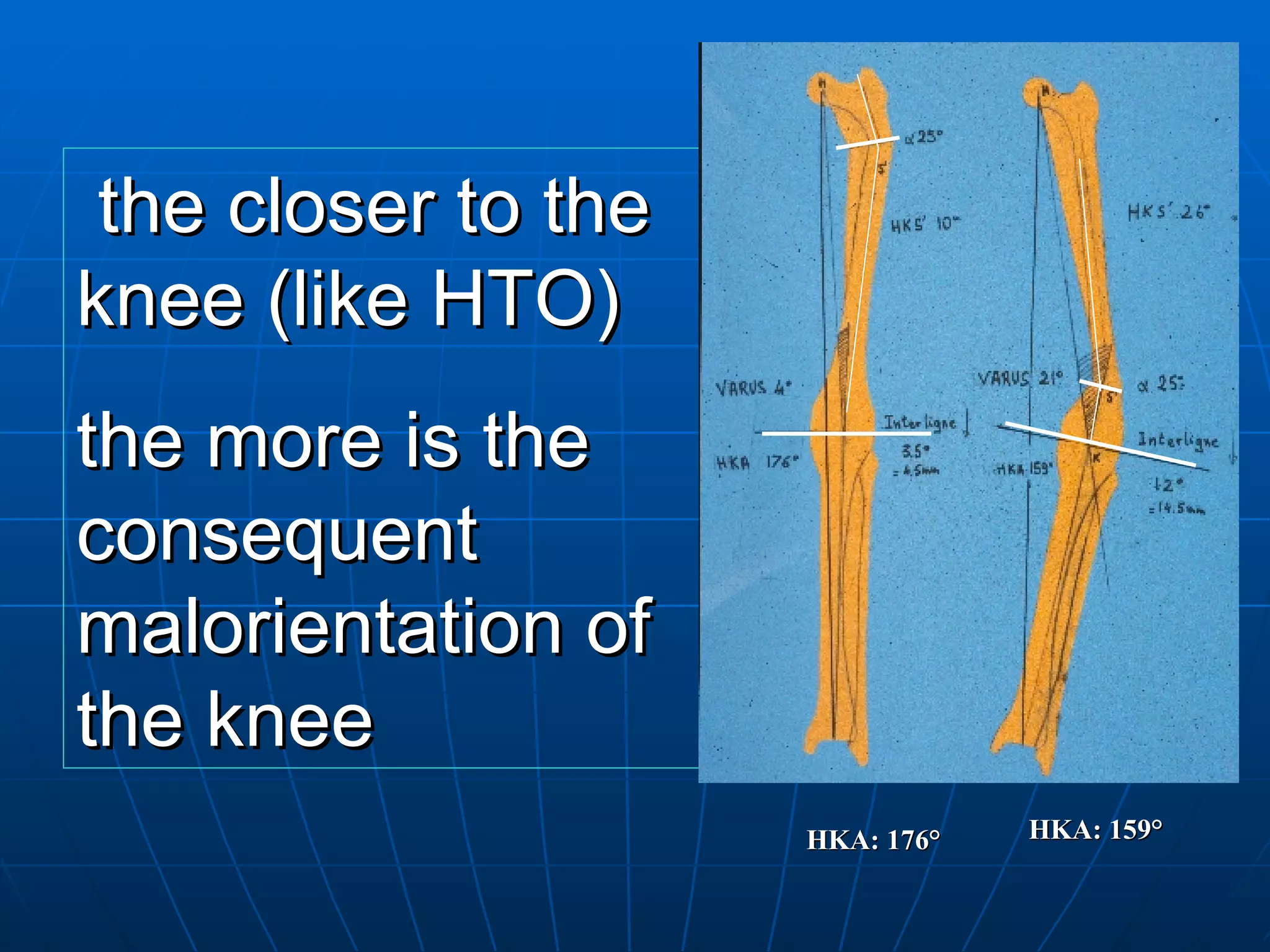 Briard Jl. How To Correct Extra Articular Deformity. Slide 15 26 | PPT