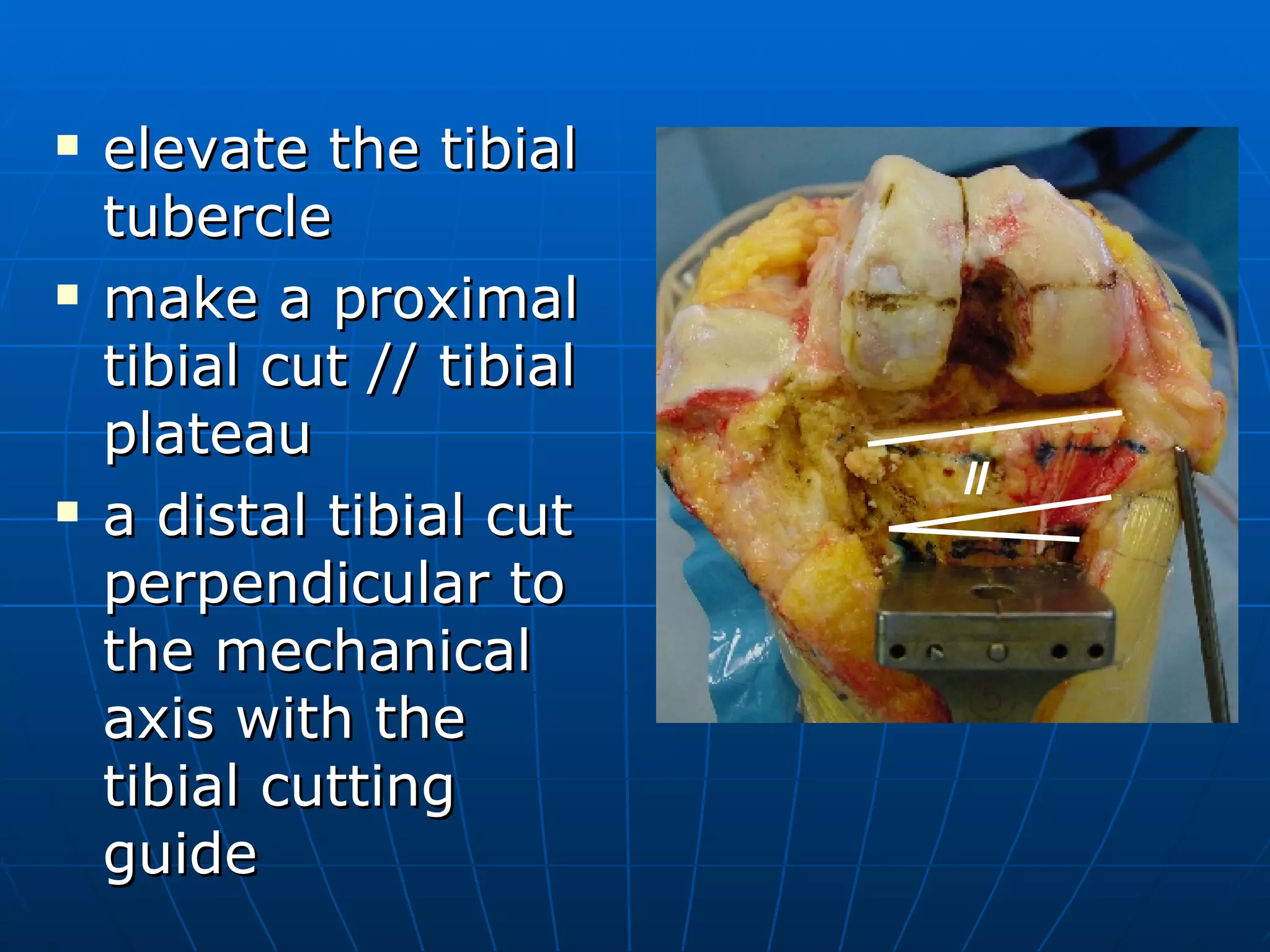 Briard Jl. How To Correct Extra Articular Deformity. Slide 41 56 | PPT