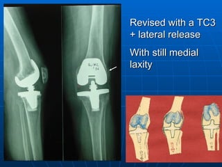 Briard Jl. How To Correct Extra Articular Deformity. Slide 41 56 | PPT