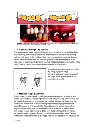 Bridge and Pontic Design .pdf